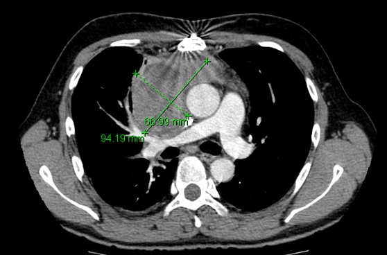 LNH diffus à grandes cellules B - Lymphoma Care